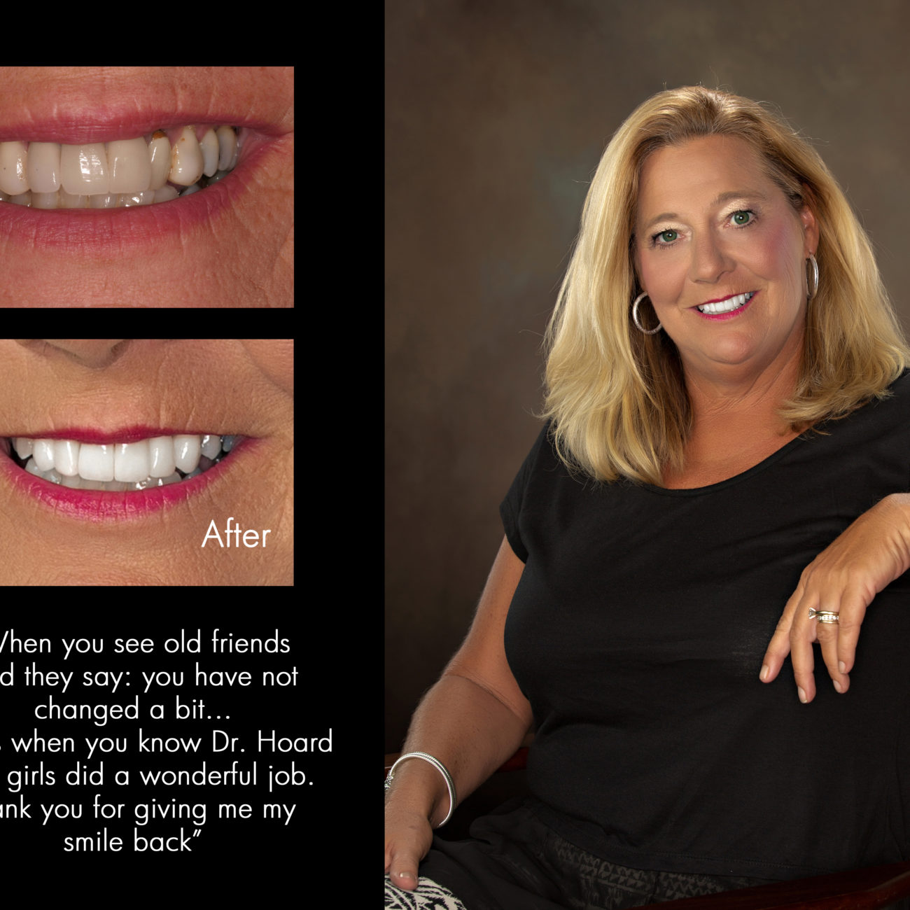 Tooth Cavity New Bern NC | Fix Cavities | Tooth Decay